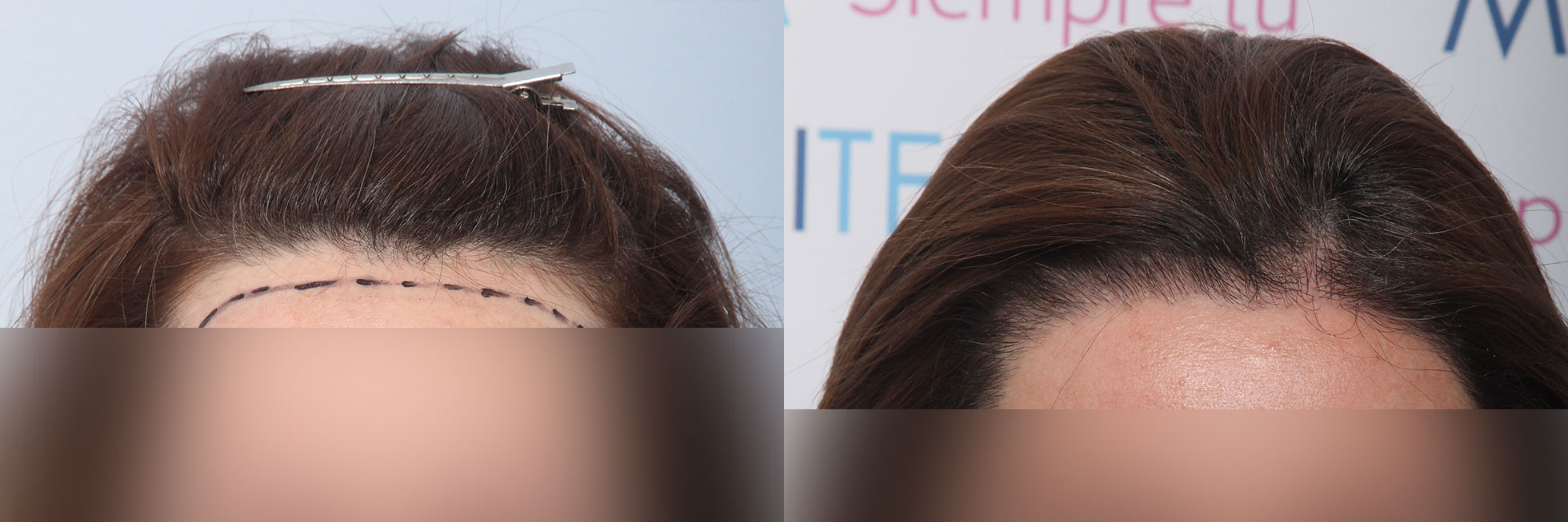 Trasplante para bajar la línea del pelo en mujer - Mediteknia